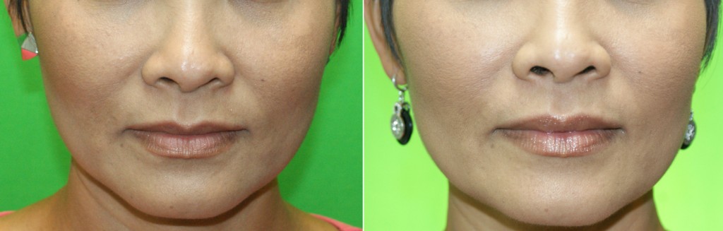 Dermal Fillers | Plastic Surgeon in Poway, San Diego CA