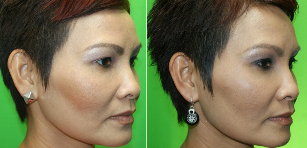 Dermal Fillers | Plastic Surgeon in Poway, San Diego CA