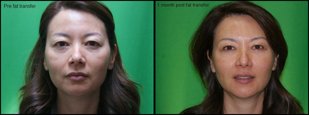 Fat Transfer | Plastic Surgeon in Poway, San Diego CA