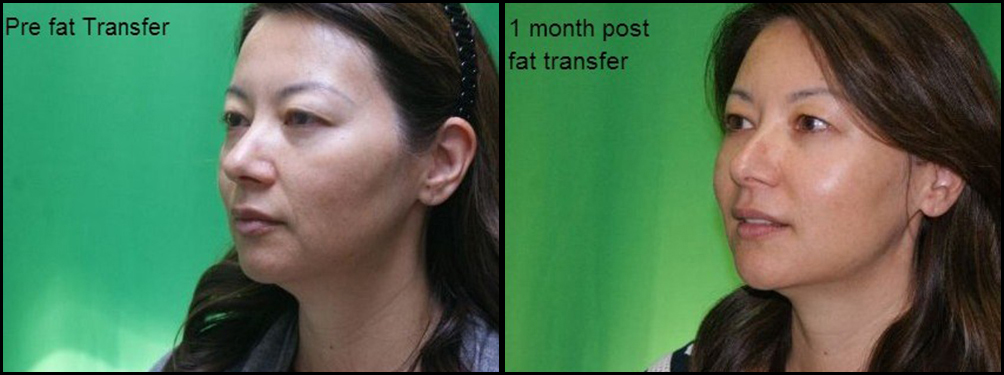 Fat Transfer | Plastic Surgeon in Poway, San Diego CA