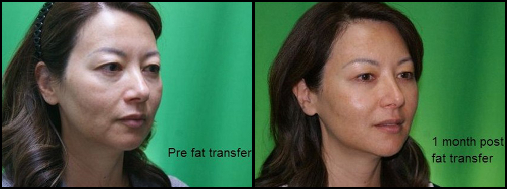 Fat Transfer | Plastic Surgeon in Poway, San Diego CA