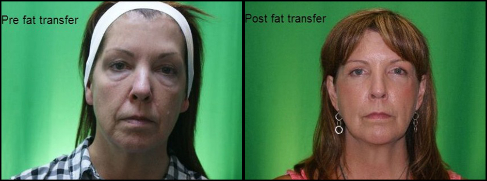 Fat Transfer | Plastic Surgeon in Poway, San Diego CA