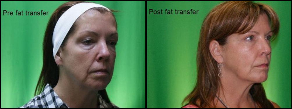 Fat Transfer | Plastic Surgeon in Poway, San Diego CA