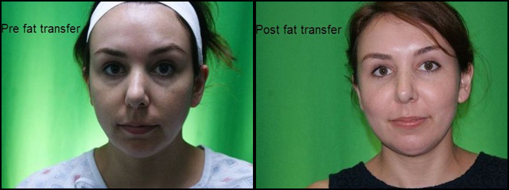 Fat Transfer | Plastic Surgeon in Poway, San Diego CA