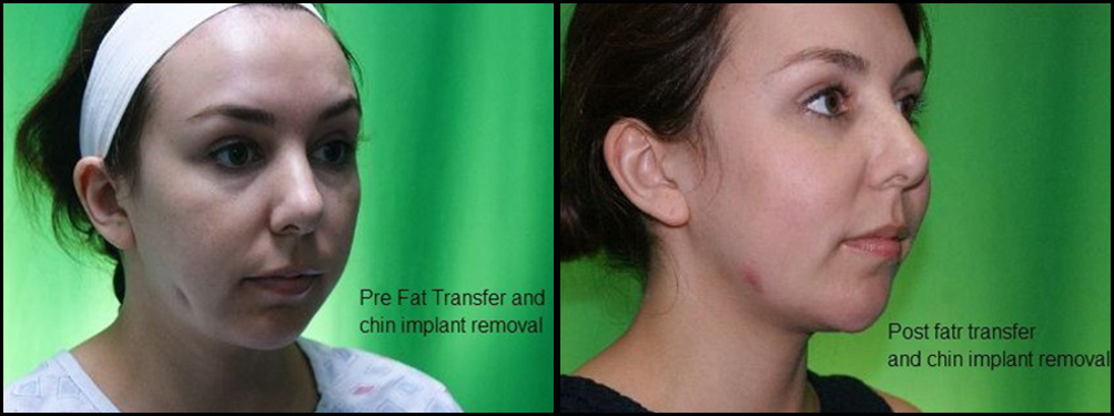 Fat Transfer | Plastic Surgeon in Poway, San Diego CA