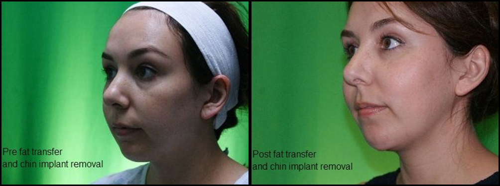 Fat Transfer | Plastic Surgeon in Poway, San Diego CA